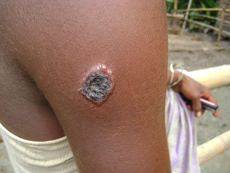 Anthrax Symptoms Anthrax Disease